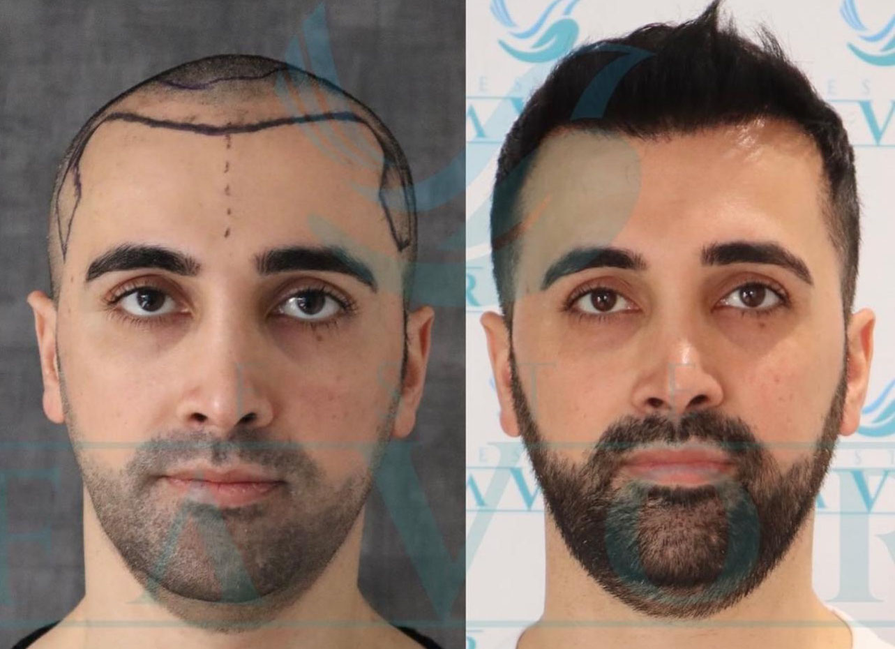 Top 5 Best Hair Transplant Clinics in Turkey and Hair Transplant Costs ...