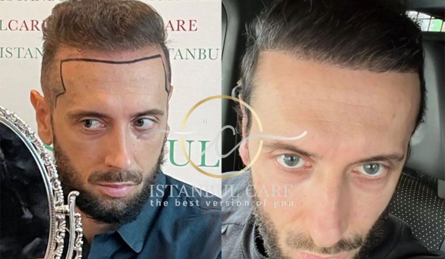 Best Hair Transplant Clinic in Istanbul: Istanbul Care - Washington Times